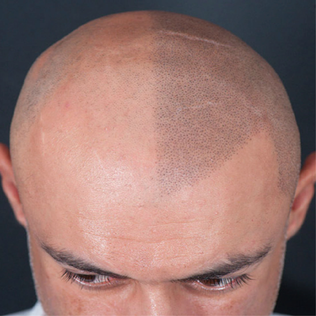 Micro Scalp Pigmentation – Concorde Beauty